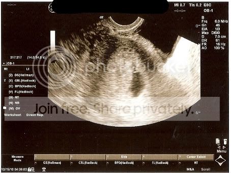 what do you see at a 6 week ultrasound? — The Bump